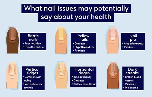 What Causes Horizontal Ridges In Fingernails